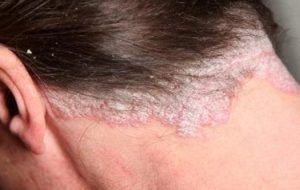 Problemi kože glave koje prati opadanje kose i efikasna rešenja