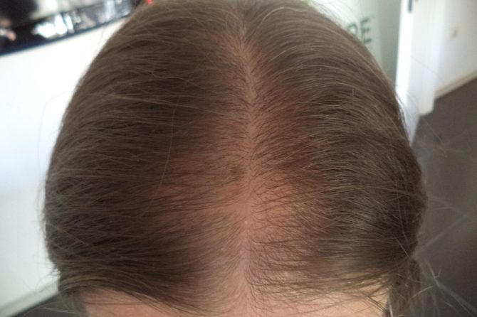 Ženska Androgena Alopecija - Uzroci i Metode Tretmana - 101 Hair Clinic