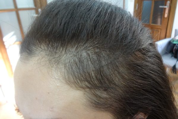 Trakciona Alopecija - Uzroci, Simptomi i Metode Tretmana - 101 Hair Clinic