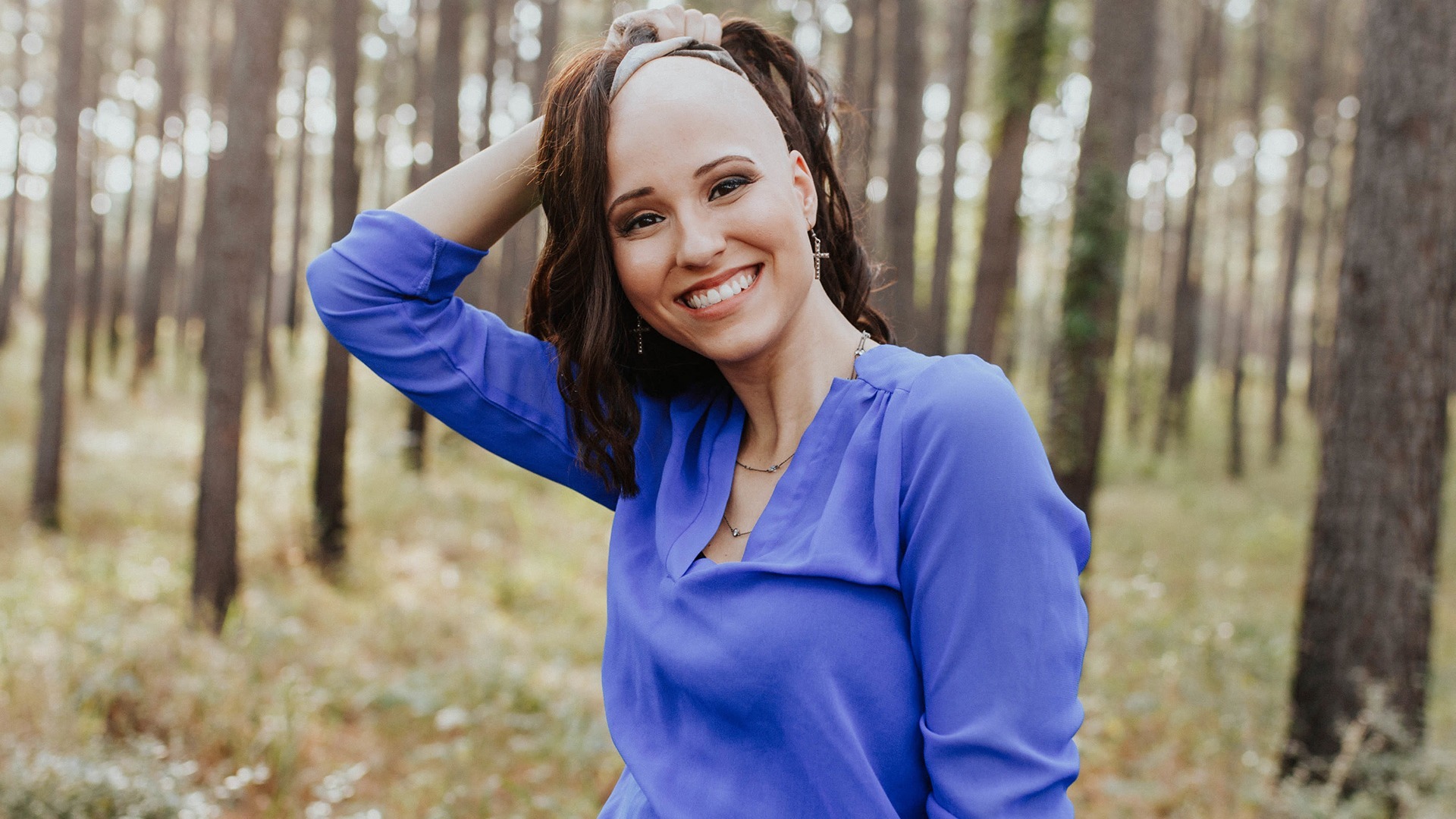 Alopecija totalis – šta kada opadne sva kosa? - 101 Hair Clinic